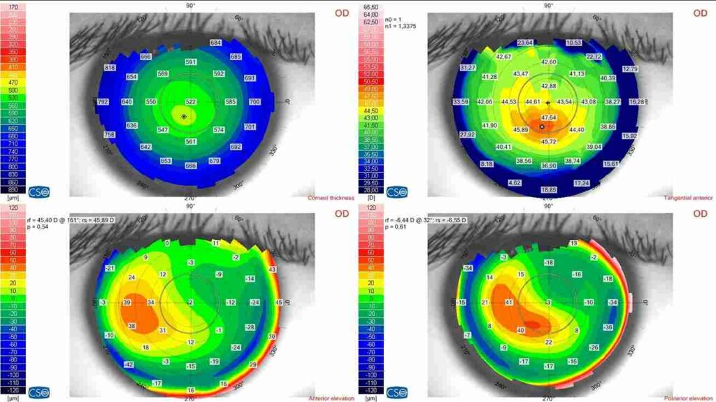 Topography Guided LASIK: Procedure, Benefits, Cost & More
